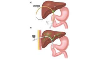 PTBD | Vascular Interventions