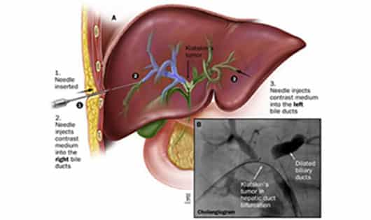 PTBD | Vascular Interventions