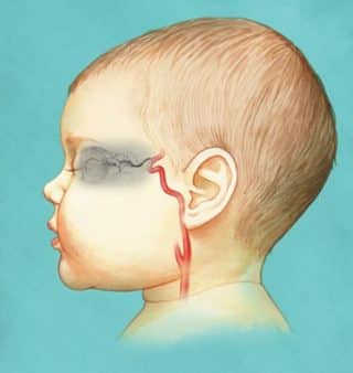Retinoblastoma-Management-IAC | Vascular Interventions